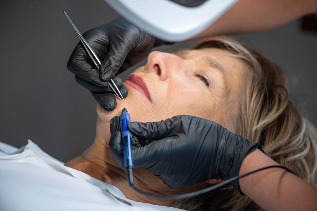 Elektrisch ontharen | Dorien.nl - Anti-Ageing Center